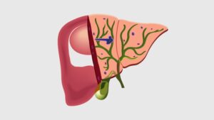 Câncer das vias biliares (colangiocarcinoma) - HepatoExperts